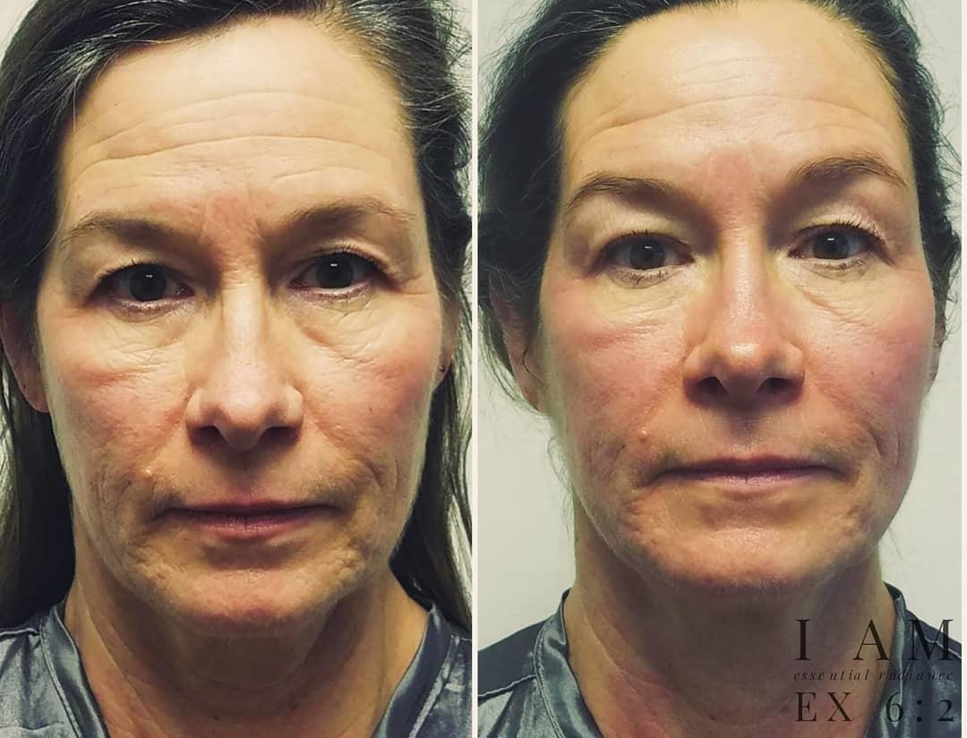 50% a Facelift Facial with Microcurrent - Essential Radiance